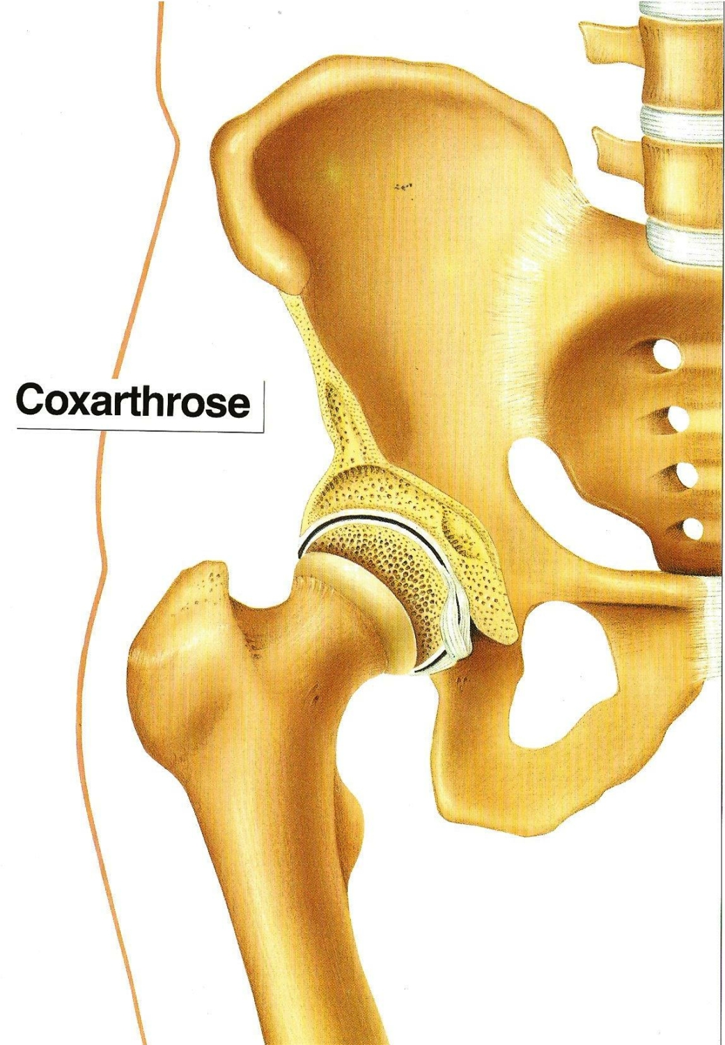 Coxarthrose : l'arthrose débutante de la hanche - Running Attitude